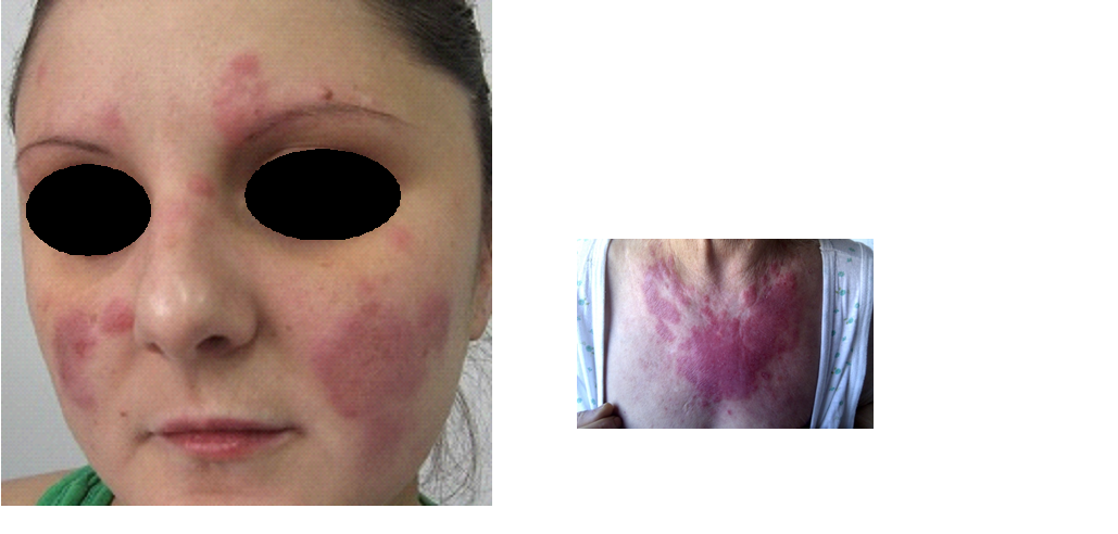 Dermatozele asociate expunerii la radiația ultravioletă