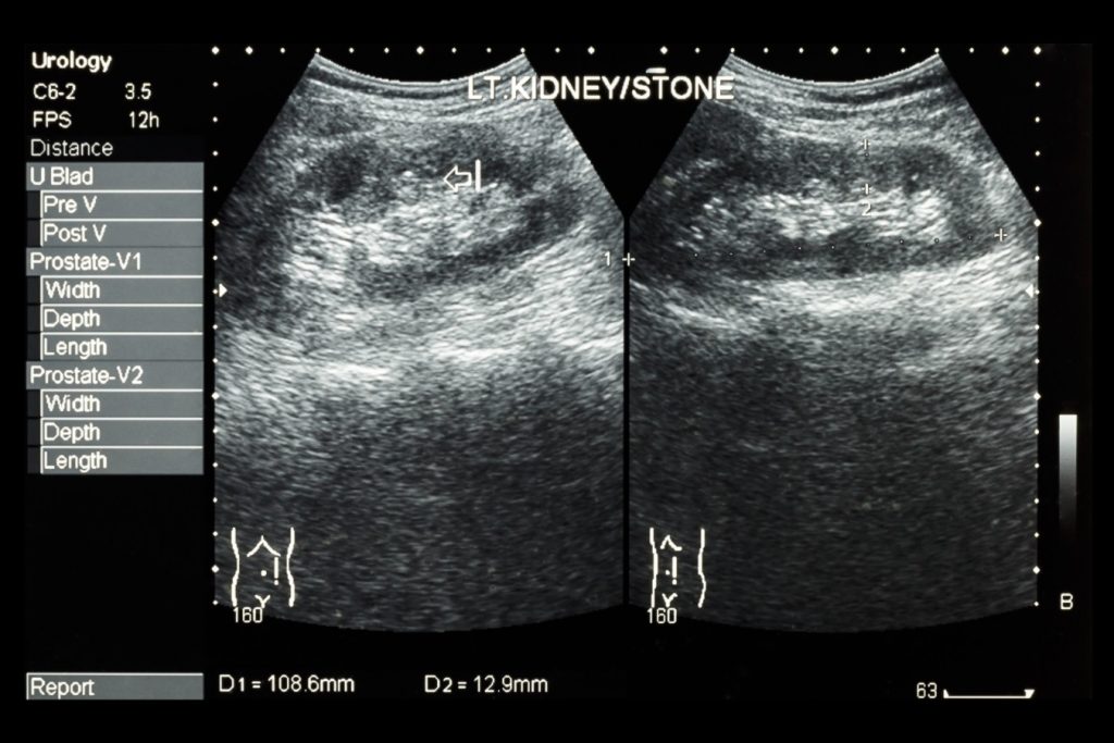 Colica renală: de la cauze și factori de risc la diagnostic și tratament