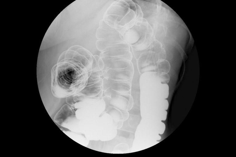 Hemoragia digestivă inferioară