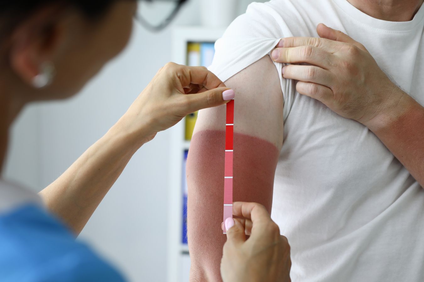 Măsuri de prim ajutor în caz de arsuri solare - Revista Galenus