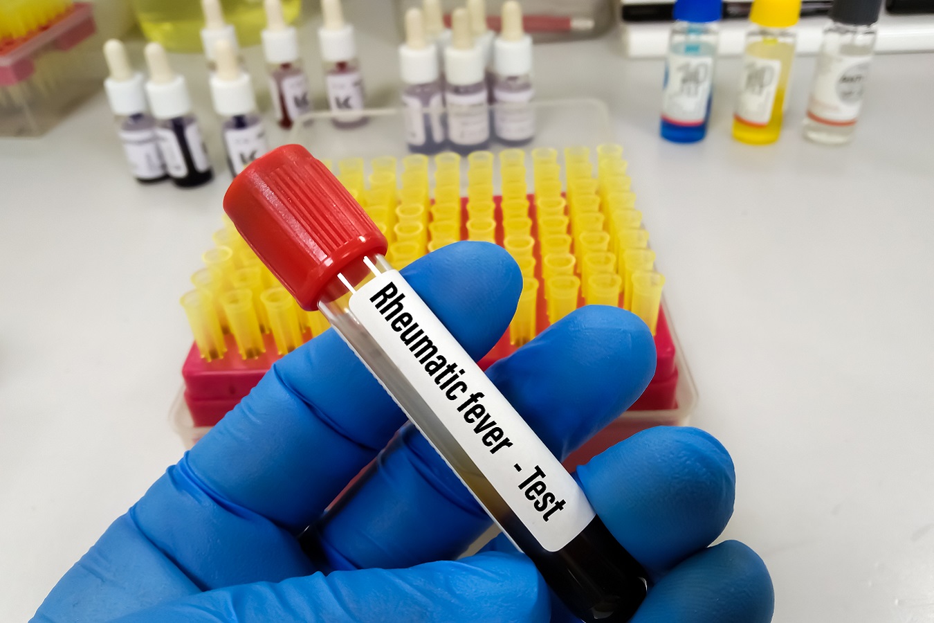 Reumatism articular acut – diagnostic și profilaxie