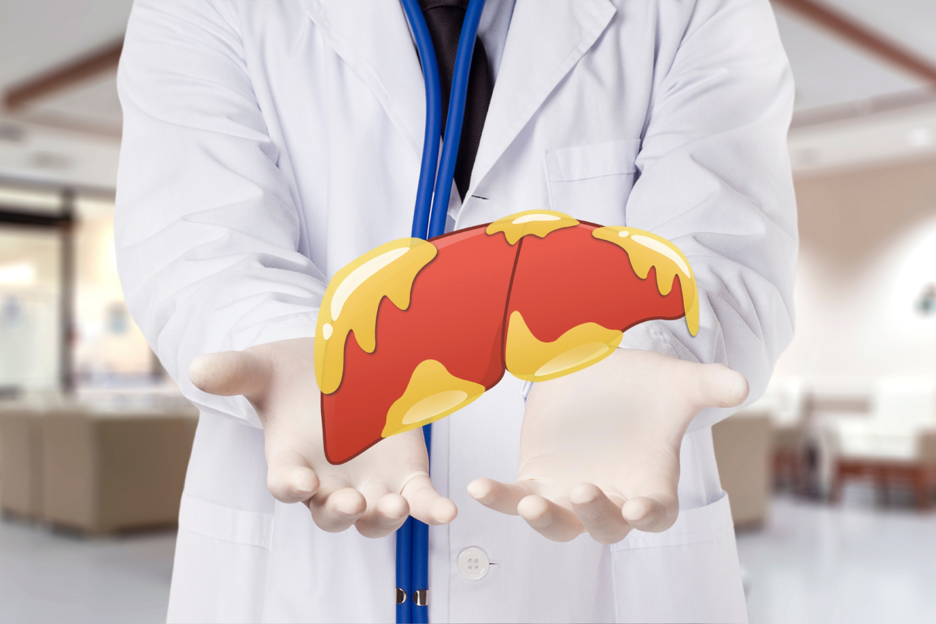Steatoza hepatică grad 2 – ficat gras forma moderată